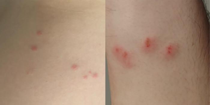 Jak poznat kousnutí od štěnice | Vyhubime.cz